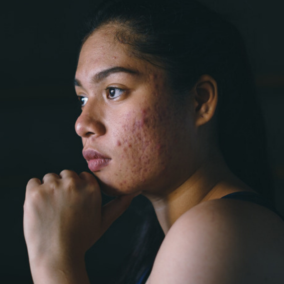 Acne – More Clinic Co